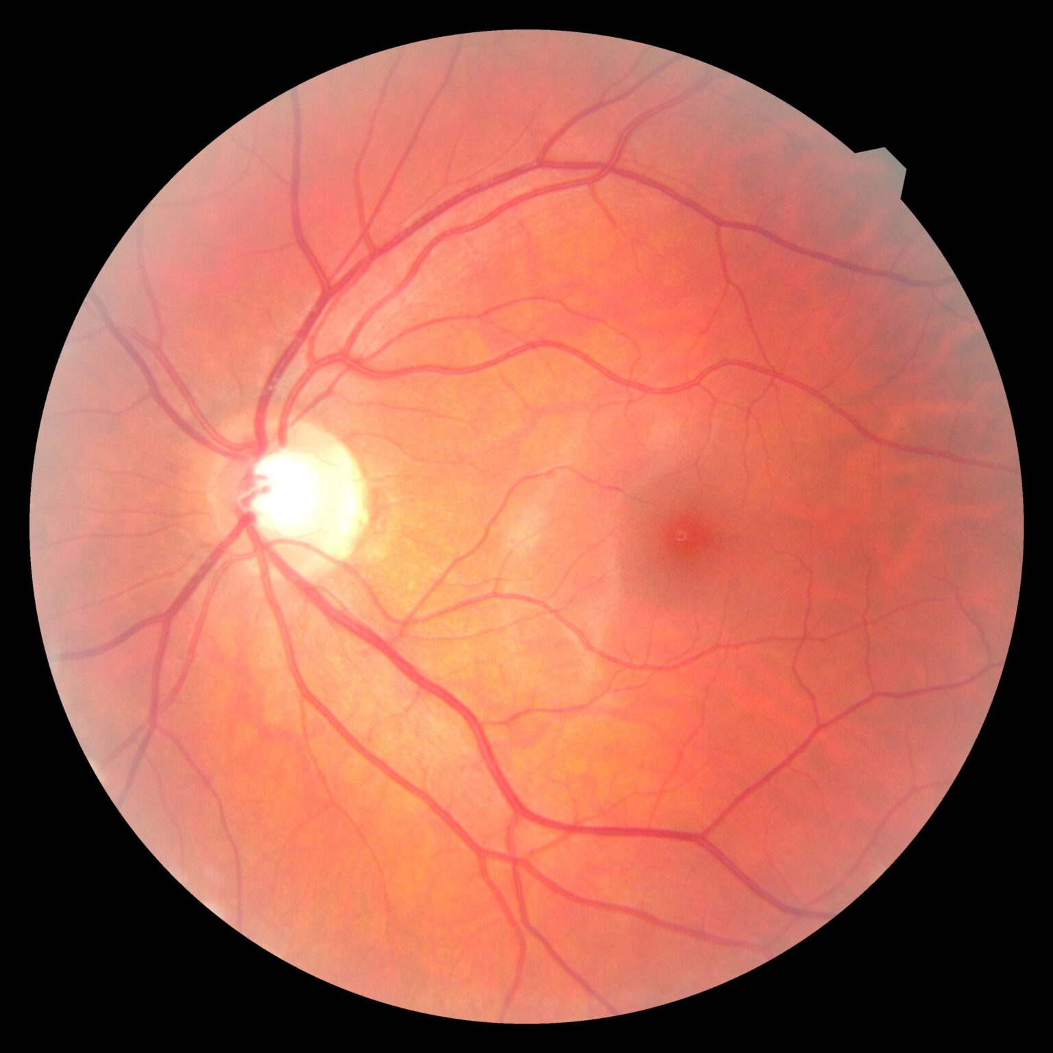 Say Cheeeeeeese! Why taking a photo of your retina is super important ...